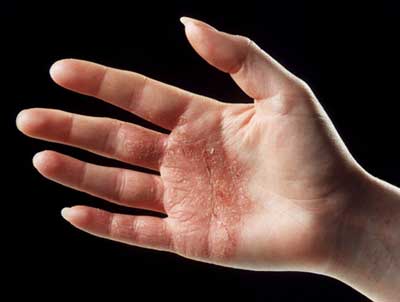 Neurodermitis geht unter die Haut - Mensch - derStandard.at › Wissenschaft