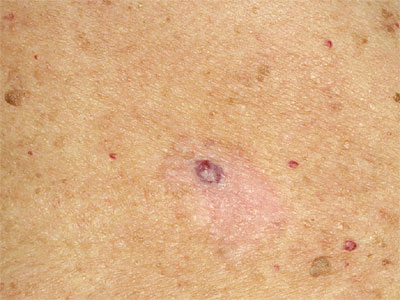 Ansichtssache: Hautkrebsvorstufen und weißer Hautkrebs - Krebs ...