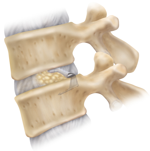 Neue OP-Technik: Bandscheiben reparieren - Rückenschmerzen ...