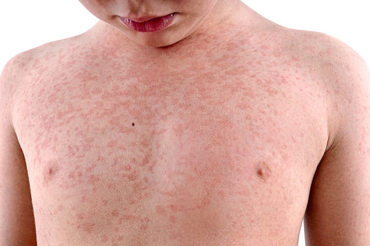 Masern: Sind Sie geimpft? - Infektionen - derStandard.at › Gesundheit